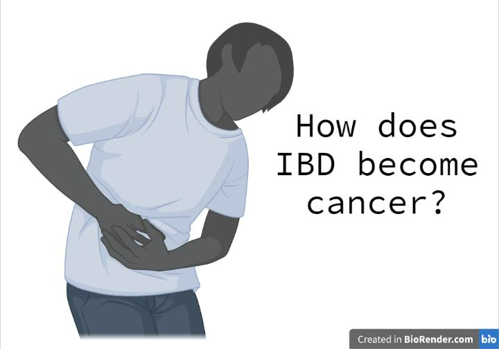 How Does Inflammatory Bowel Disease Become Cancer? – OncoBites