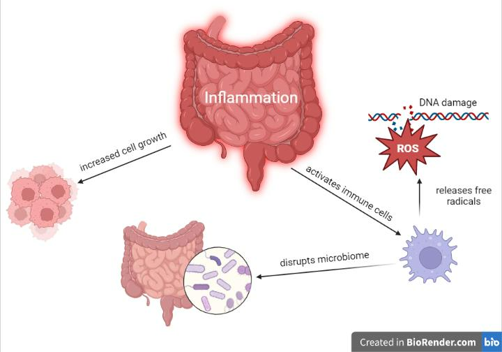 How Does Inflammatory Bowel Disease Become Cancer? – OncoBites