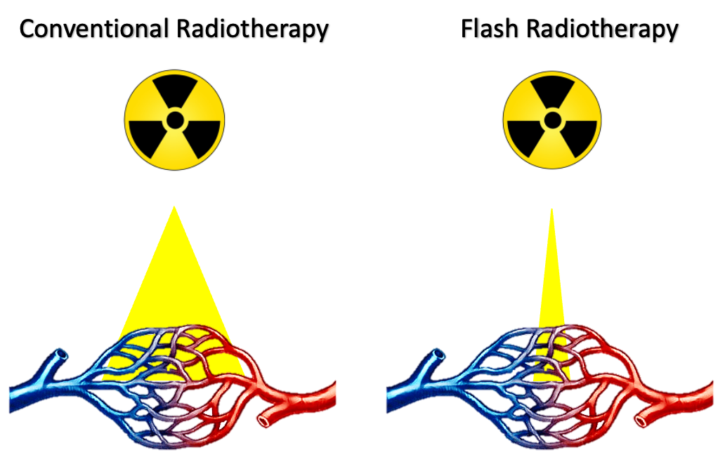FLASHy Science: Looking at New Advances in Radiation Therapy – OncoBites