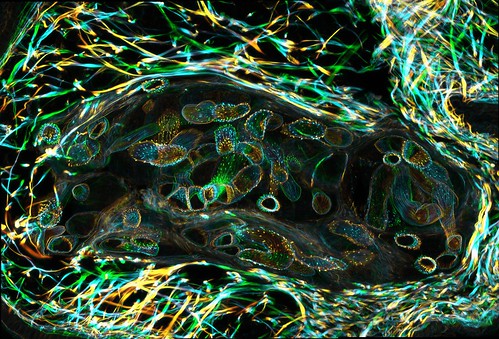 A Parasite-Cancer Relationship – OncoBites