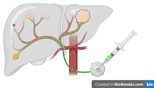 Hepatic Arterial Infusion Chemotherapy – OncoBites